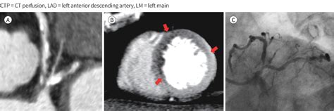 Figure 5 From 전산화단층촬영 관상동맥조영술 분획혈류예비력과 심근관류 영상 Semantic Scholar