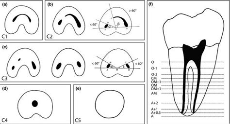 Recent Classification Of C Shaped Root Canals A C1 Root Canal In
