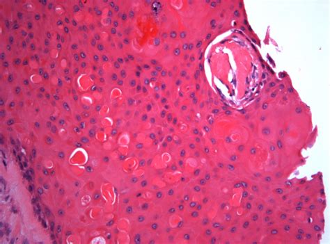 Proliferating Trichilemmal Tumor Proliferating Tricholemmal Tumor