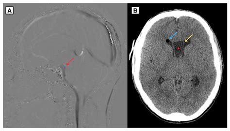 Symptomatic Cavum Septum Pellucidum And Vergae Cyst A Case Report
