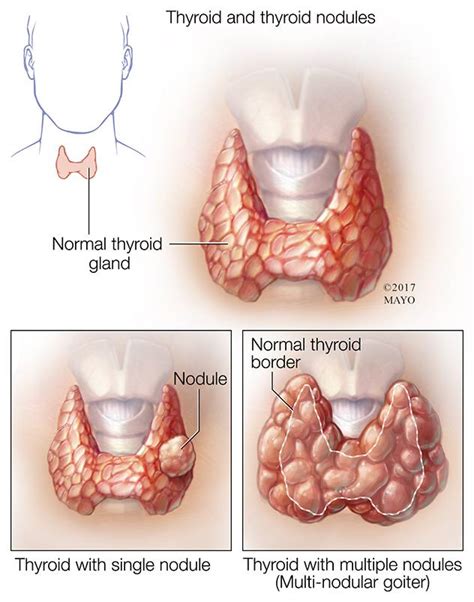 Thyroiditis Types Causes Symptoms Diagnosis Treatment 56 Off