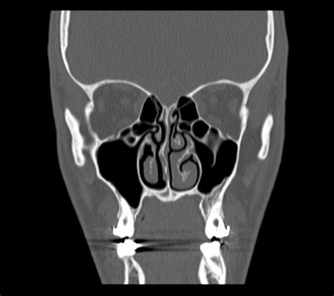 Infraorbital Ethmoidal Air Cells Pacs