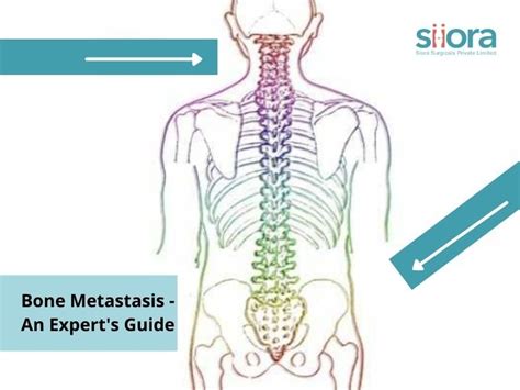 Bone Metastasis An Experts Guide Siora Surgical