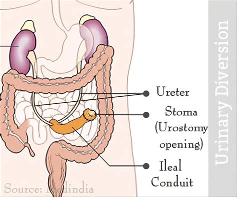 Ileal Conduit