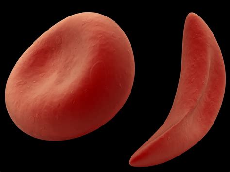 Centro Médico Frei Caneca Anemia Falciforme Requer Cuidado Por Toda Vida