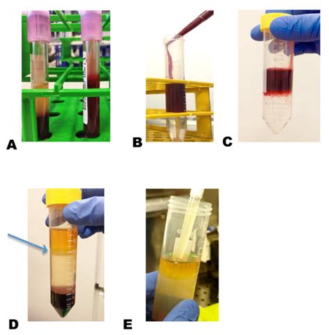Isolation Of PBMCs From Whole Blood Blood Drawn From A MCL Patient Is Download Scientific