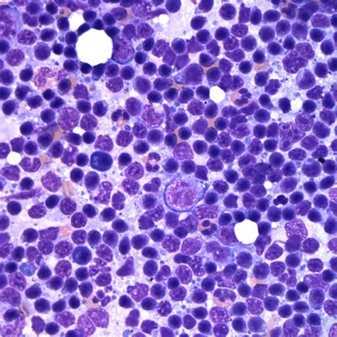 Lymph Node Eclinpath