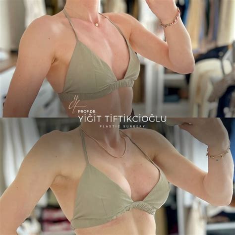 Breast Augmentation Before And After