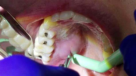 Tooth Abscess Drained In The Mouth Youtube