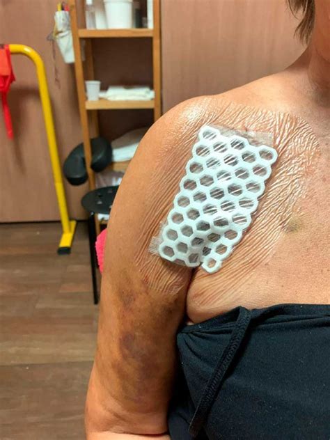 ¿sabías Que Hay Diferentes Tipos De Prótesis De Hombro Clínica De