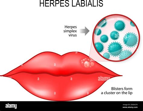 Herpès Labial Durée Herpès Labial Causes Principales Ibrb