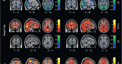 What Is The Test Retest Reliability Of Common Task Fmri Measures New Empirical Evidence And A