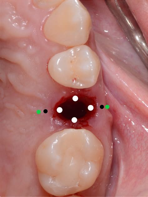 The White Spots Correspond To The Points Of The Post Extraction Socket