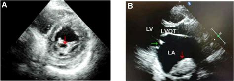 Echocardiographic Confirmation Of Rhd Patients Rhd Rheumatic Heart