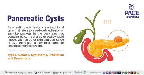 Pancreatic Cysts Types Symptoms Causes Treatment Prevention