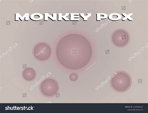 Monkey Pox Background Monkeypox Pustules On เวกเตอร์สต็อก ปลอดค่า