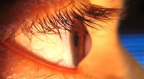 Ceratocone Oftalmologia Especializada