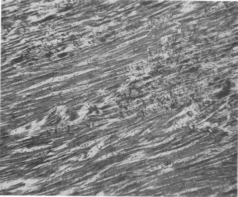 Focal Myocardial Necrosis Within The Left Ventricular Wall Of A