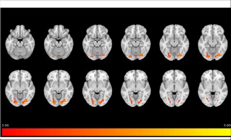 Voxel Based Morphometry Gray Matter Volume Enlargements While Viewing Download Scientific
