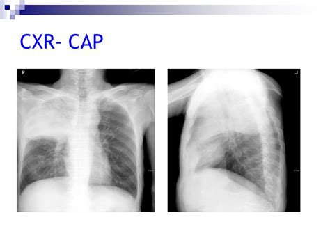 Ppt 임신과 호흡기 질환 Powerpoint Presentation Free Download Id3862841