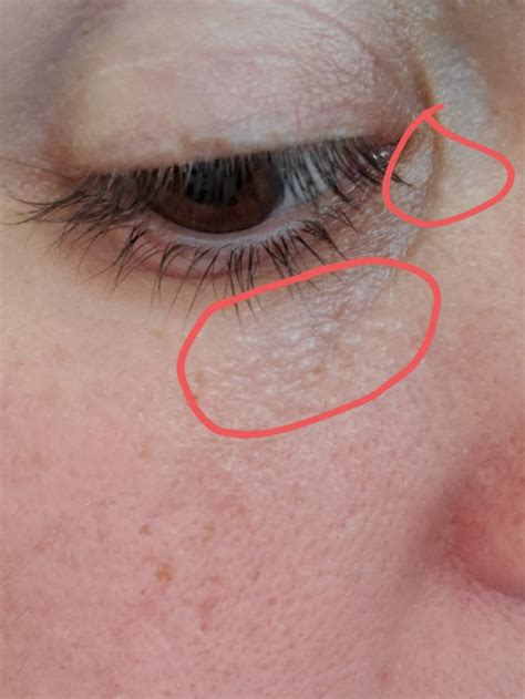 Flat White Spots Under Eyes Theatrenaw