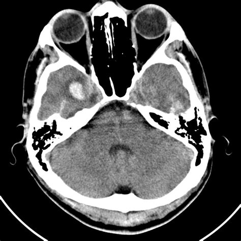 Cerebral Contusion By Alexander Baxter Radnotes