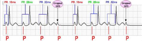 Waveforms Pictures Flashcards Quizlet