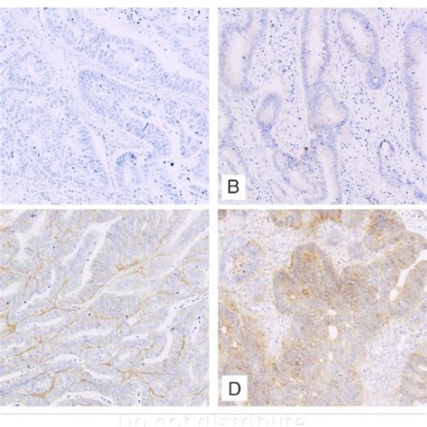 Representative Examples Of Egfr Intensity Staining In Colorectal