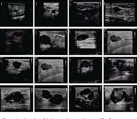 Figure 1 From Automatic Classification Of Benign And Malignant Breast