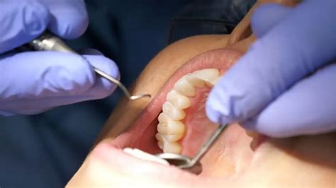 13 Reasons Why You Have A Bump On The Roof Of Your Mouth