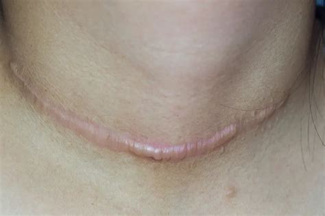 Thyroid Removal Surgery Thyroidectomy