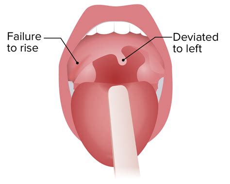 Uvula Deviation