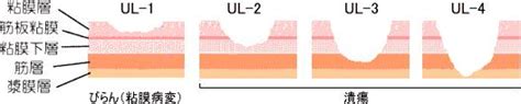 胃潰瘍の深さによる分類 痛くない経鼻内視鏡検査をお探しの方は新横浜のららぽーと横浜クリニックへ