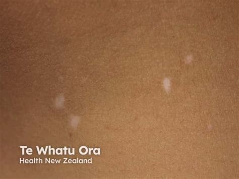 Vitiligo Images — Dermnet