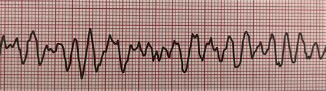 Recognizing Arrythmias With Nurse Brennan — Medliant