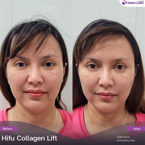 Hifu Before And After Photos Siam Clinic Thailand