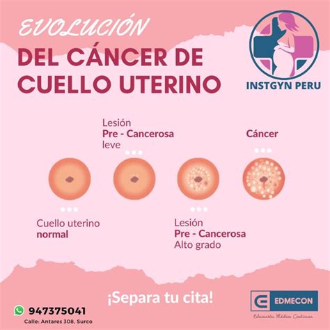 Evolucion Del Cancer De Cuello Uterino Instgyn