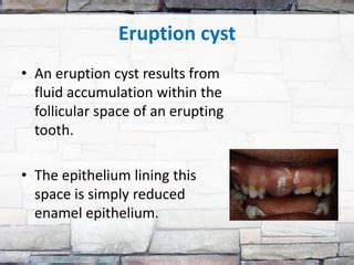 Causes Of Odontogenic Cyst Pptx