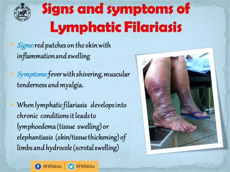 Lymphatic Filariasis Causes Symptoms Treatment