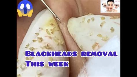 Blackheads Remove This Week Acne Extraction Pimple Popping 44 Youtube