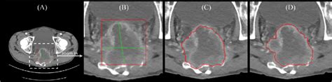 13 Example Of Automatic Lesion Segmentation With Weakly Supervised