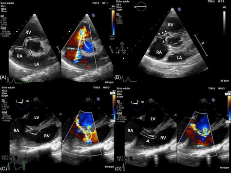 Different Short‐axis Views A B Of 2d Tte With Color Doppler Download Scientific Diagram