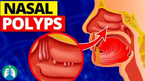 What Does A Nasal Polyp Look Like On Face Images And Symptoms Pictures