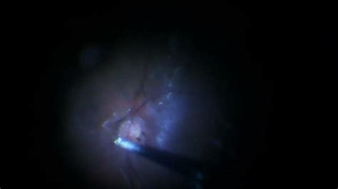 Tough Posterior Hyaloid Youtube