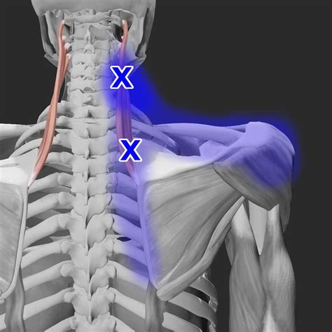 Levator Scapulae Syndrome What Is Dorsal Scapular Nerve Entrapment