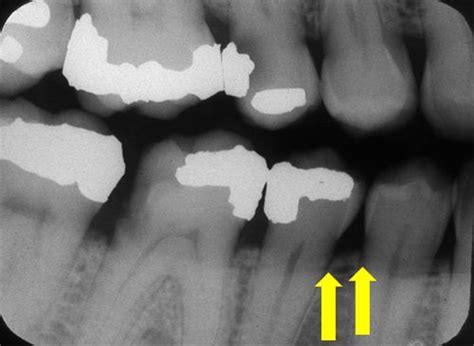 Caries Interpretation Root Caries Root Caries Cari Root