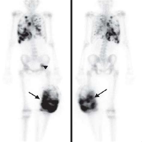 4a And B A 16 Year Old Male With Osteosarcoma Of Left Femur Planar Download Scientific