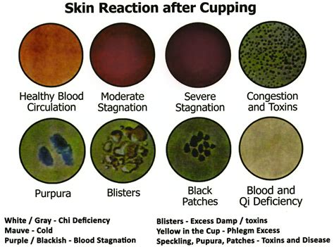 Cupping Therapy Color Chart Educational Chart Resources