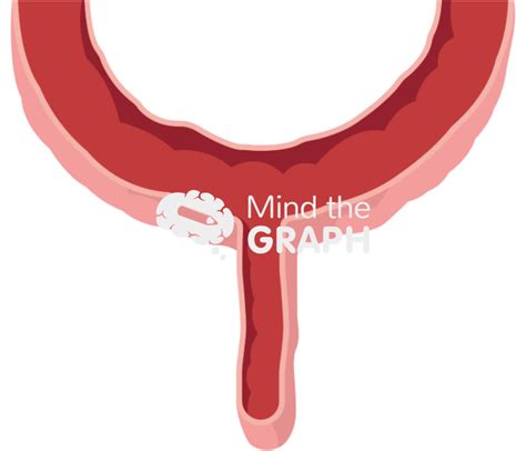 Meckels Diverticulum