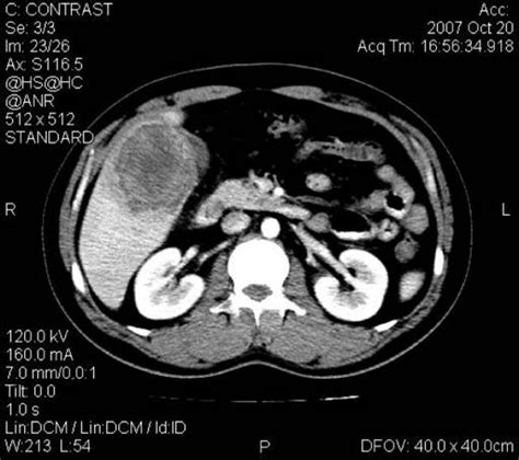 Computed Tomography Image Computed Tomography Contrast Enhanced Image